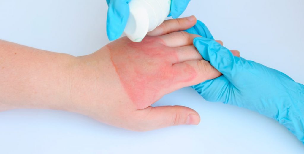 Servicio Unidad de Quemados – Hospital Universitario de Santander